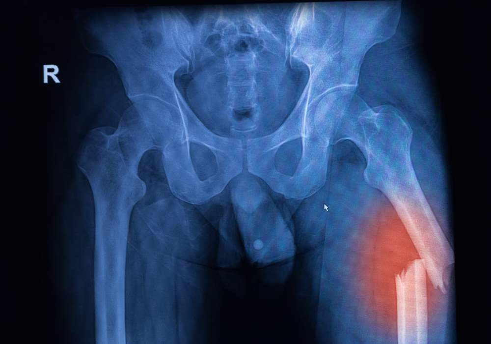 Rotura de Fémur en Personas Mayores: Recuperación y cuidados